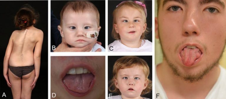 Síndrome de Moebius: Rehabilitación para mejorar funciones